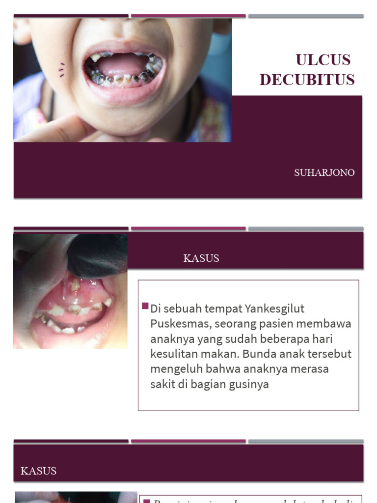 Ulcus Decubitus - 2024 | PDF