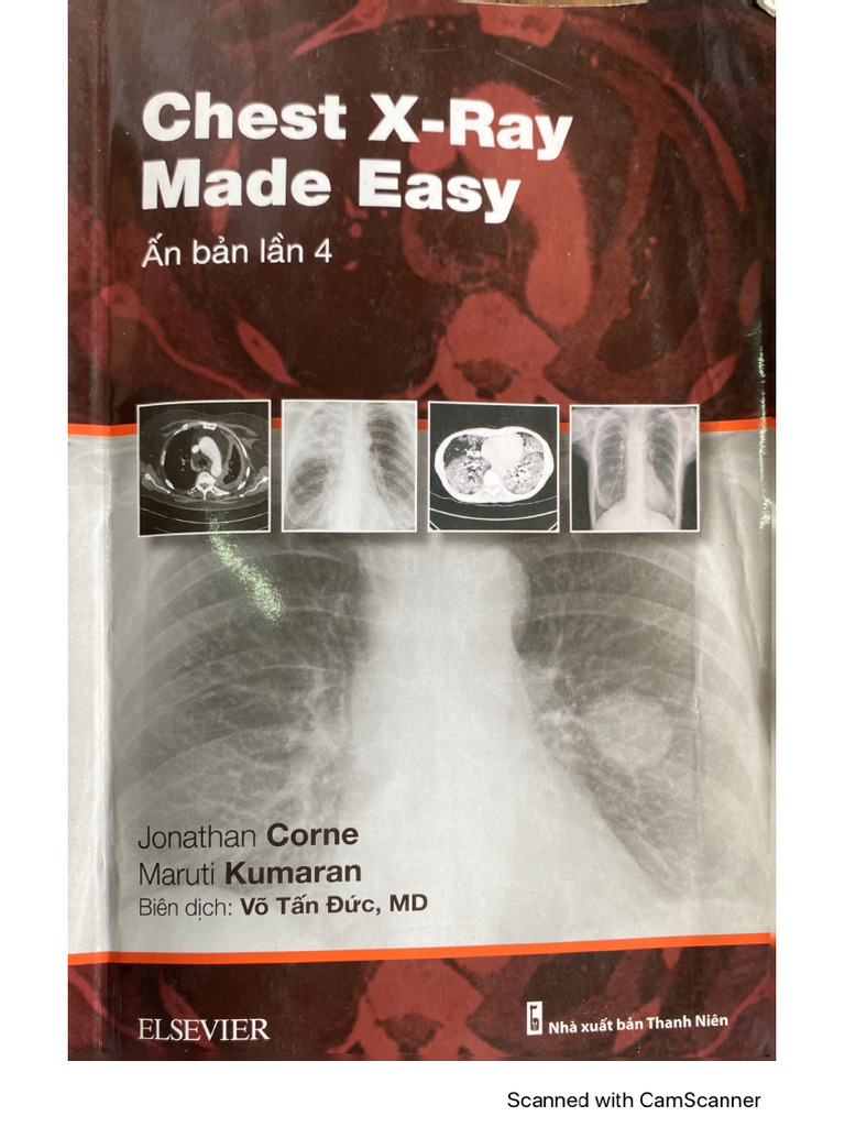 Chest X-Ray Made Easy | PDF