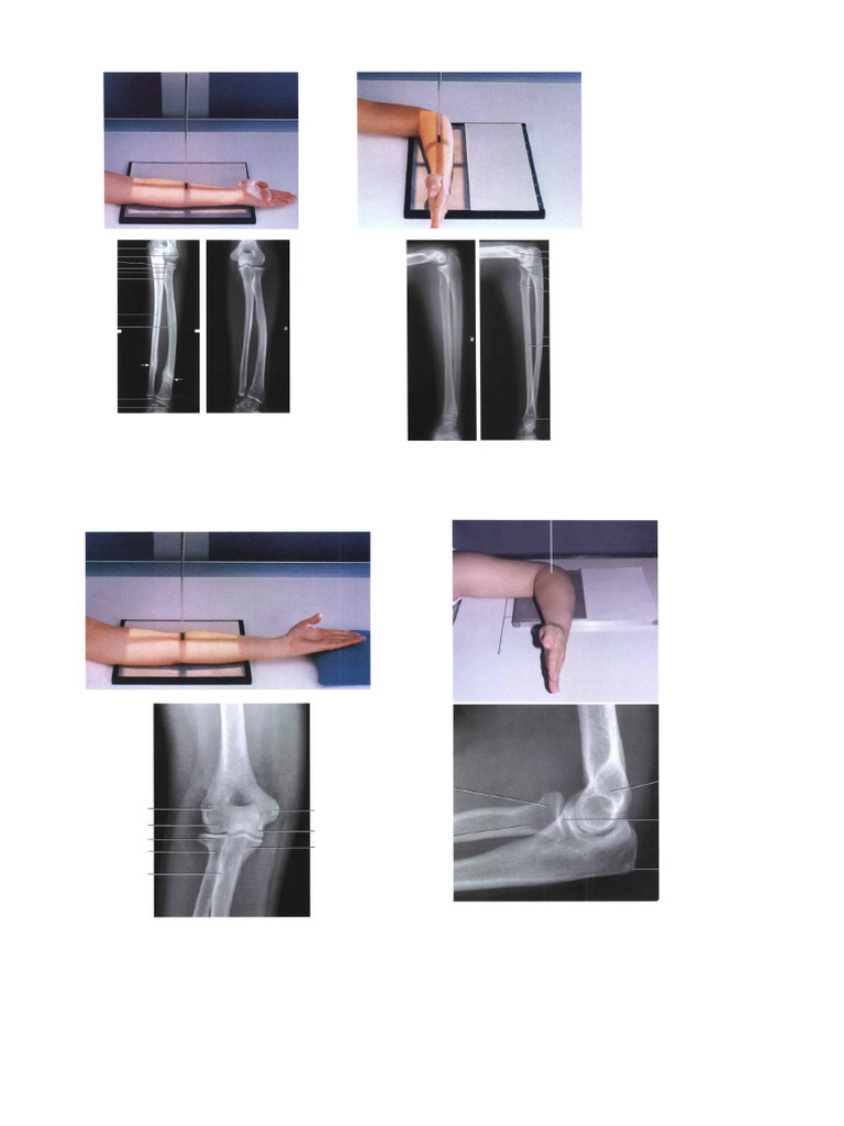 Antebrachi Dan Elbow Gambar TP | PDF