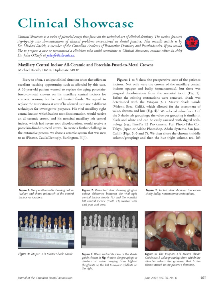 Clinical Showcase: Maxillary Central Incisor All-Ceramic and Porcelain ...