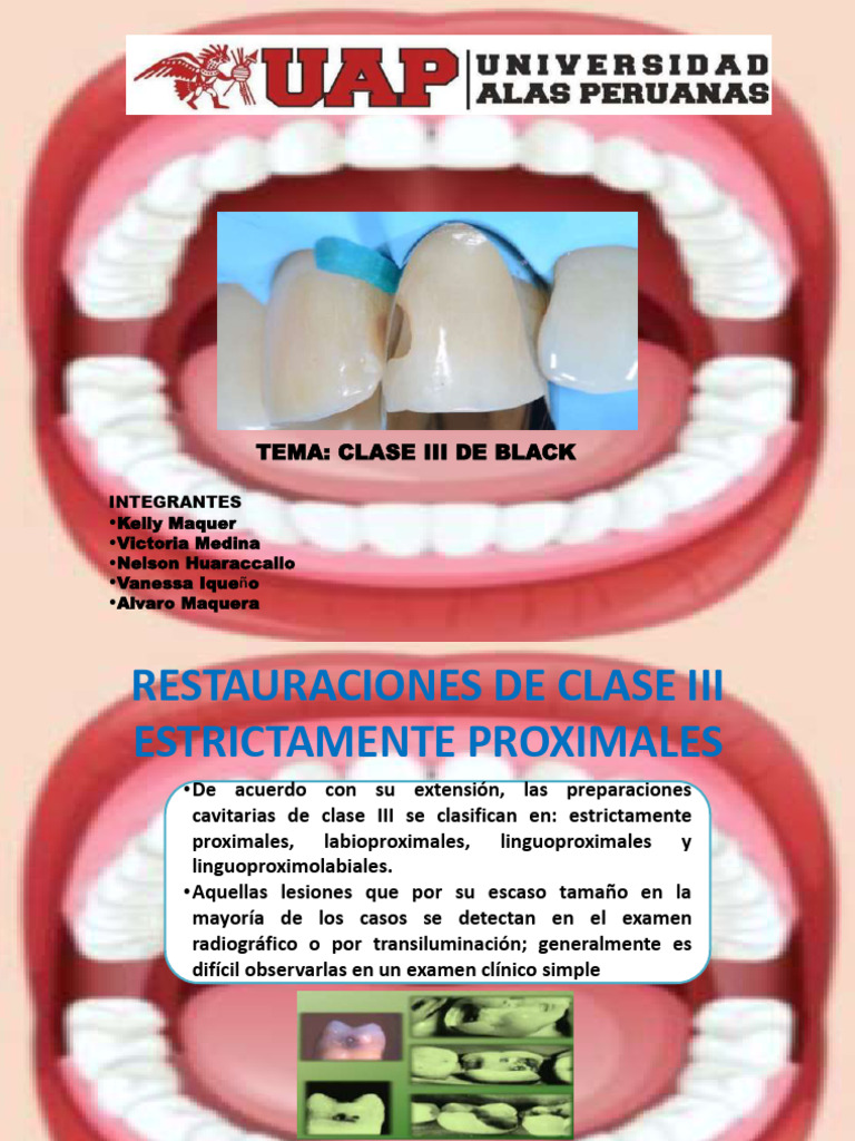 Restauración Clase III de Black | PDF | Compuesto Dental | Boca