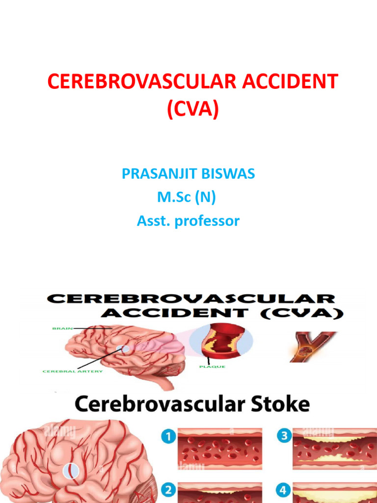PPT On CVA (Stroke) | Download Free PDF | Stroke | Ischemia
