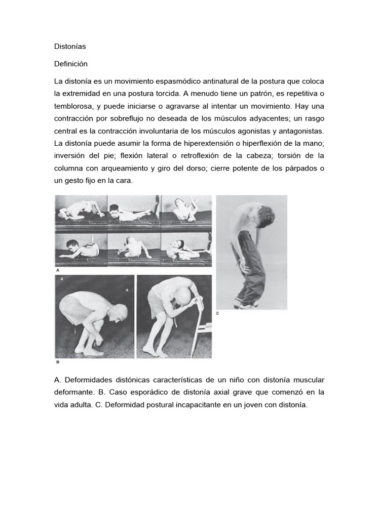 Distonía Axial y Laríngea: Definición y Diagnóstico | PDF | Distonia ...