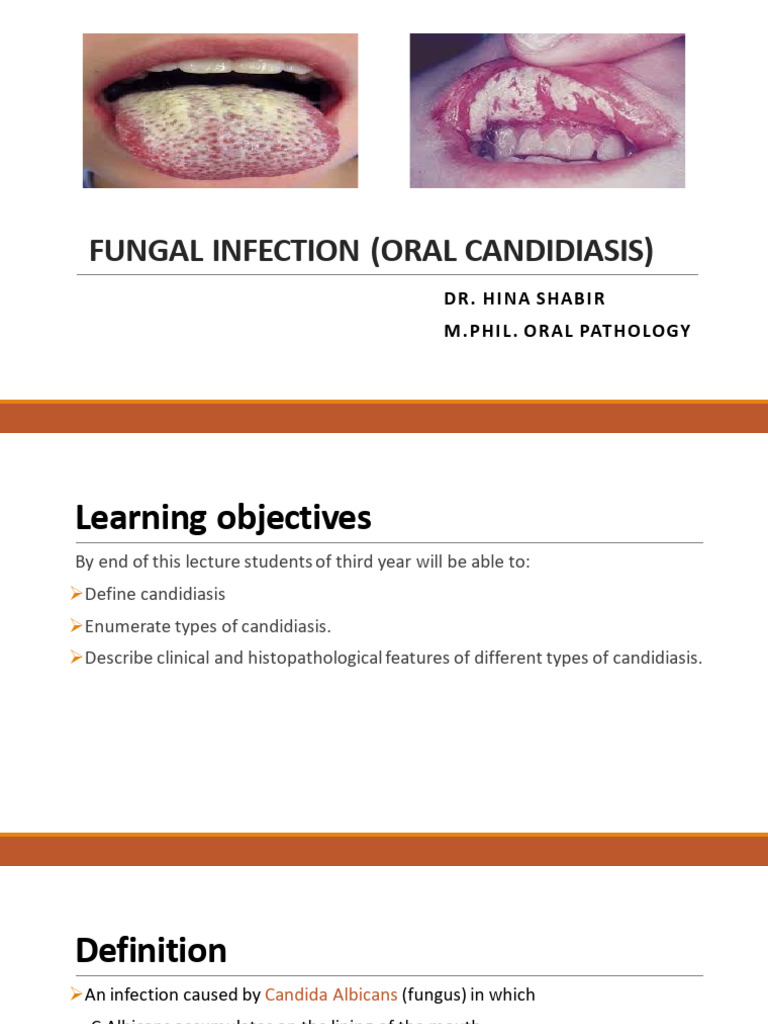 FUNGAL INFECTION (Oral Candidosis | PDF | Candidiasis | Clinical Medicine