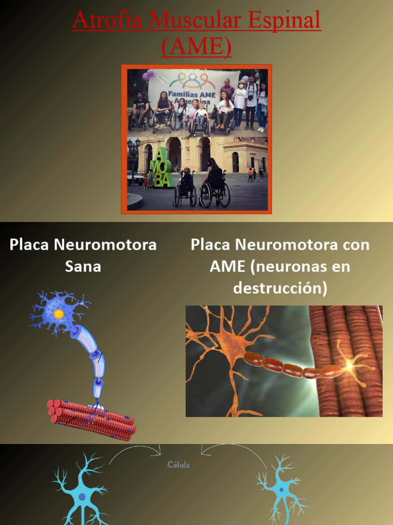 Atrofia Muscular Espinal: Tipos y Tratamientos | PDF | Medicina ...