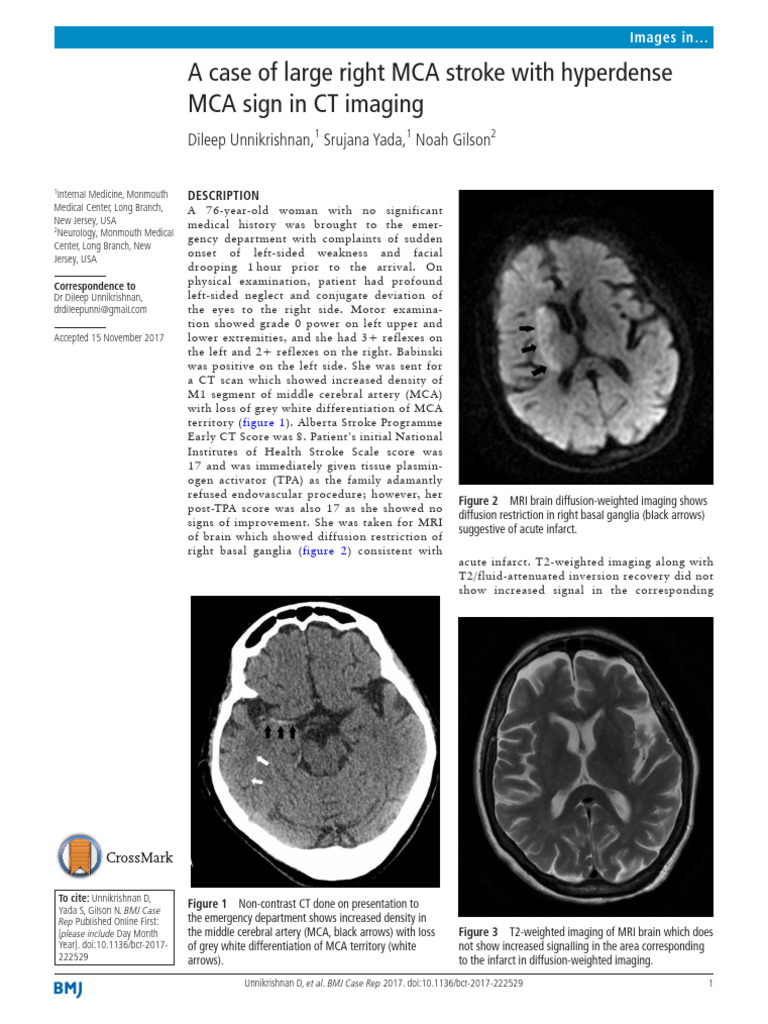 Case Report Mca | Download Free PDF | Stroke | Magnetic Resonance Imaging