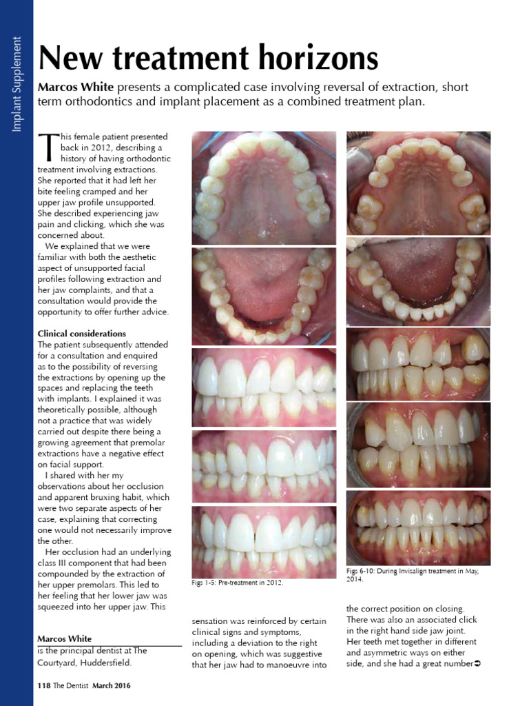 pg118 120 Implants New Treatment Horizons Marcos White Final | PDF | Dental Implant | Dentistry