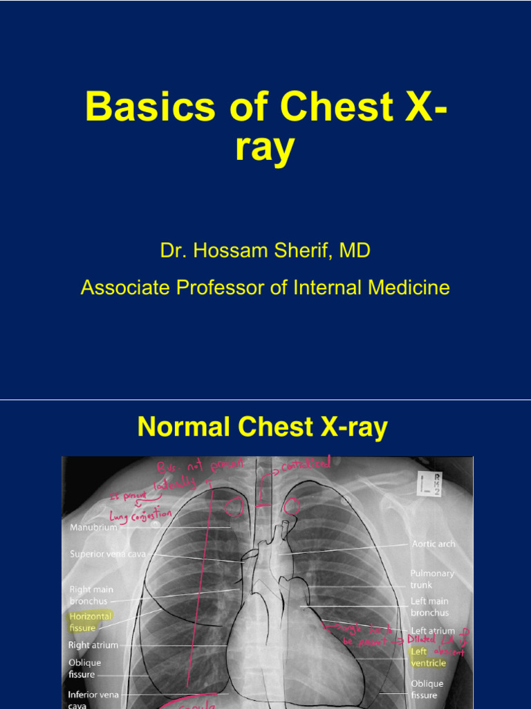Chest X Rays | PDF