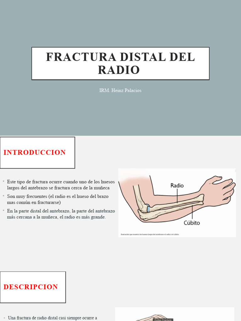 Fractura Distal de Radio | PDF | Cirugía | Hueso