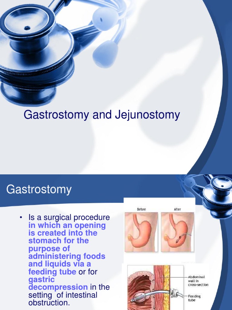 Jejunostomy vs. Gastrostomy Overview | PDF | Intravenous Therapy | Medicine