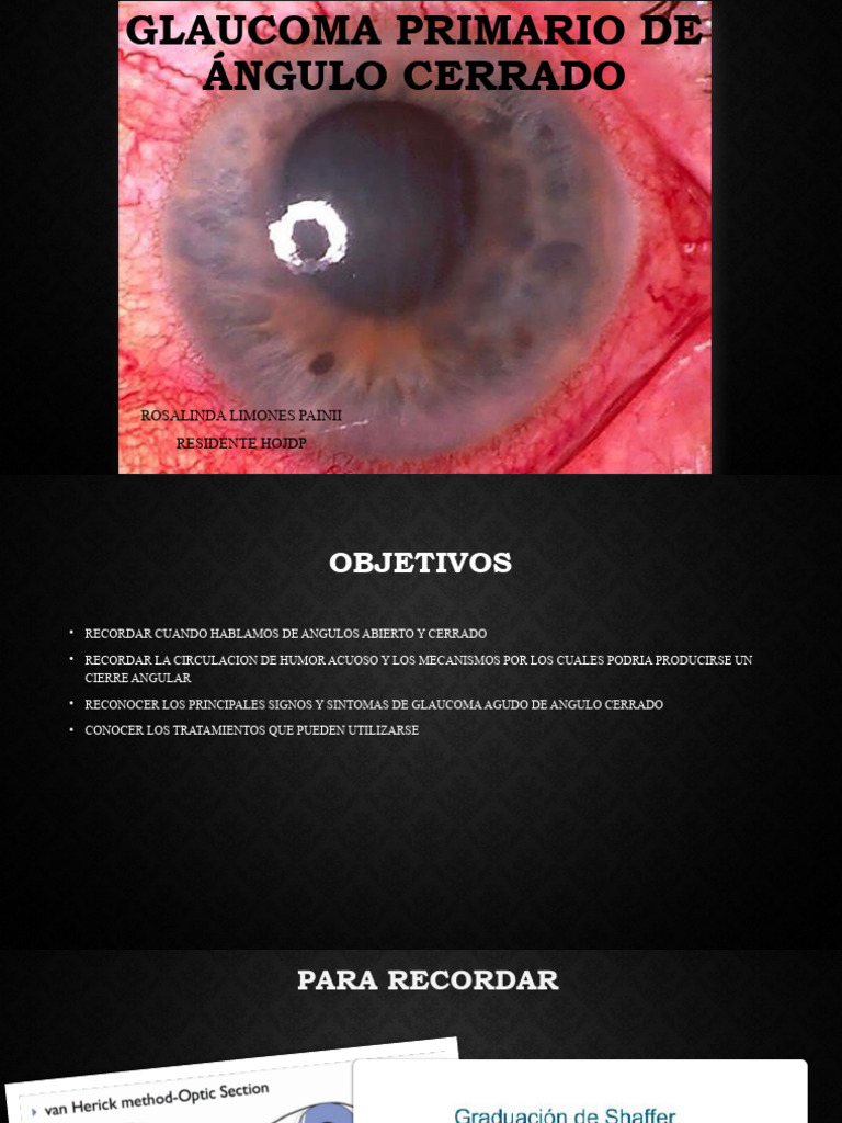 Glaucoma Primario de Angulo Cerrado | PDF | Glaucoma | Especialidades ...