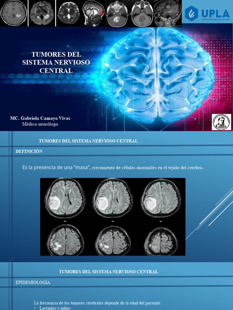 4. tumores cerebrales | PDF | Tumor cerebral | Neoplasias