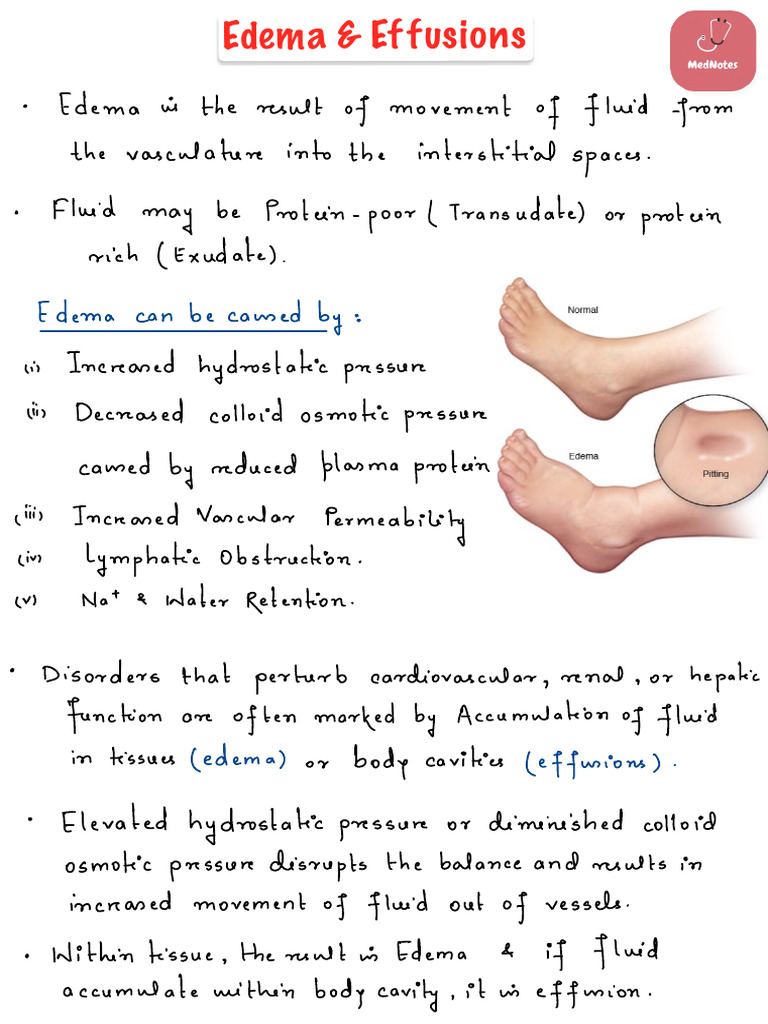 1 Edema Effusions 1 Pdf Edema Lymph