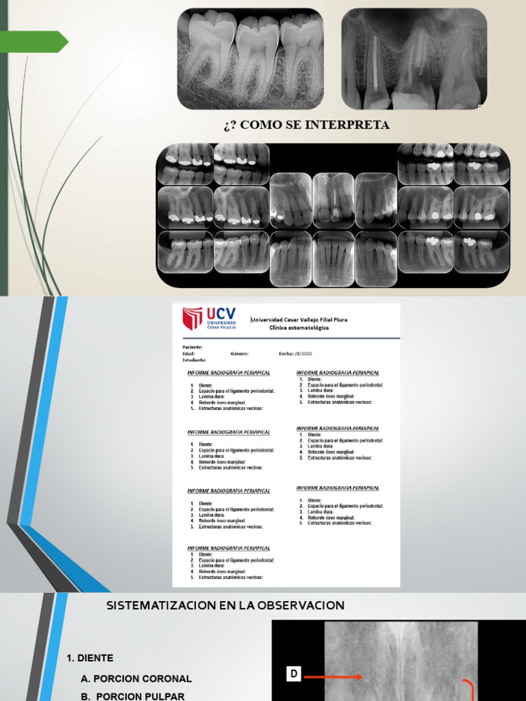 Interpretacion Rx Periapicales. Caries y Enf Periodontal | Descargar ...