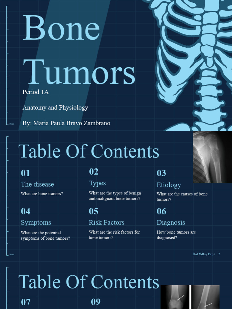 Bone Tumors | PDF | Cancer | Benign Tumor