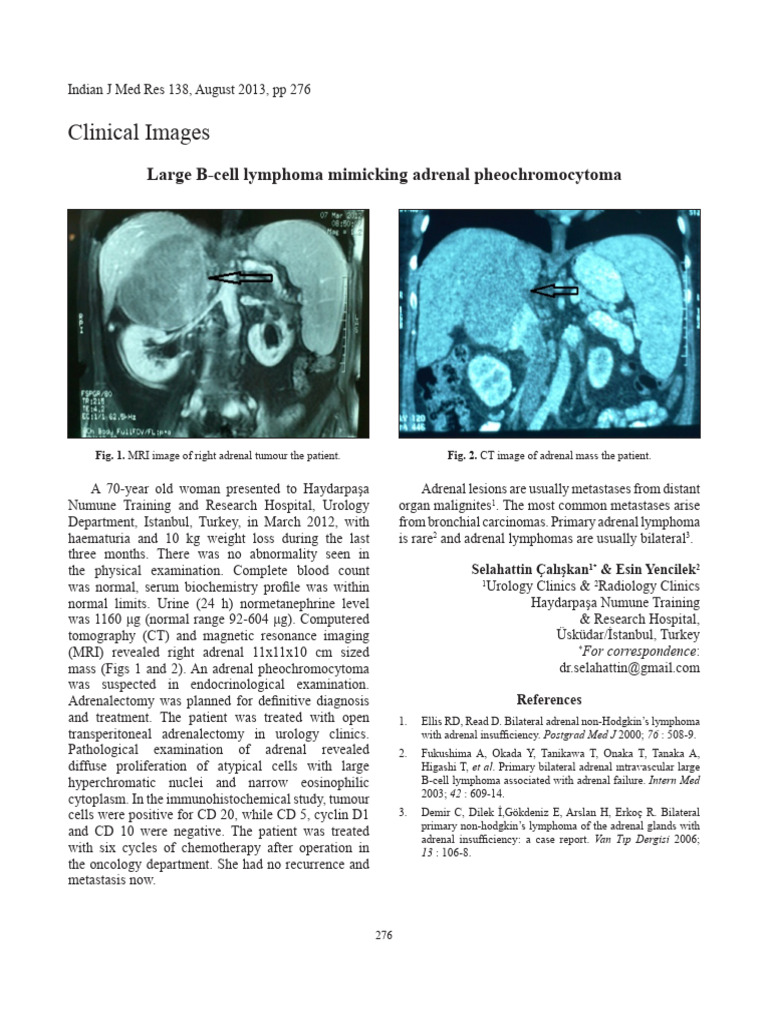 Large B-Cell Lymphoma Mimicking Adrenal Pheochromocytom | PDF ...