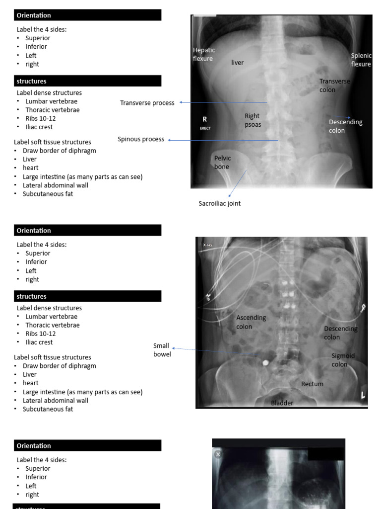 Radiology (Labled) | PDF | Large Intestine | Pelvis
