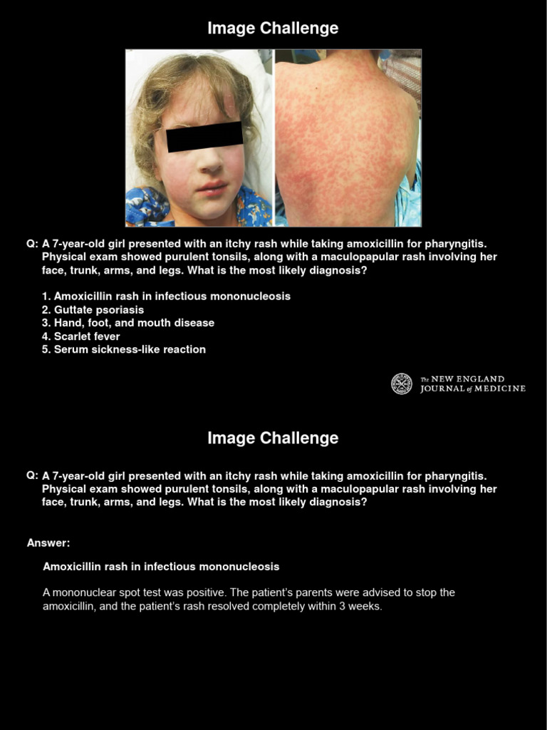 Amoxicillin rash in infectious mononucleosis | PDF