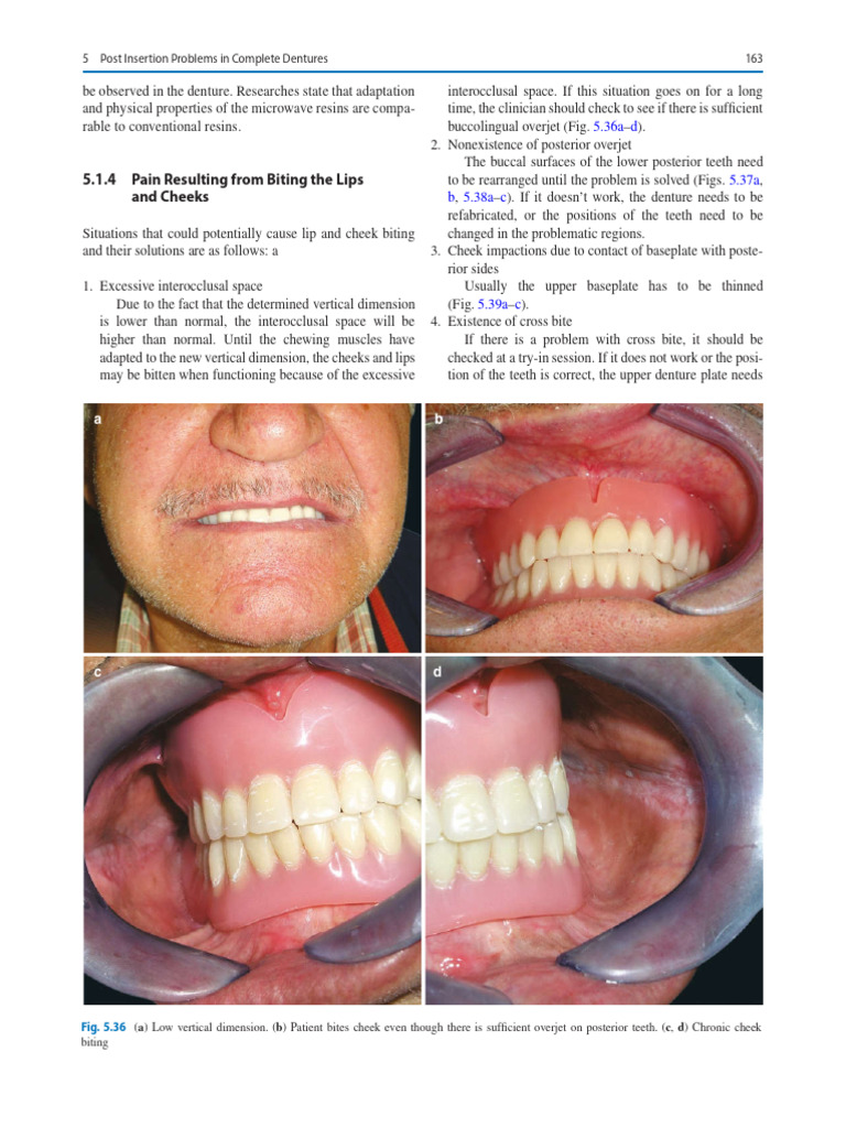 Complete Denture Prosthodontics - Treatment and Problem Solving ...