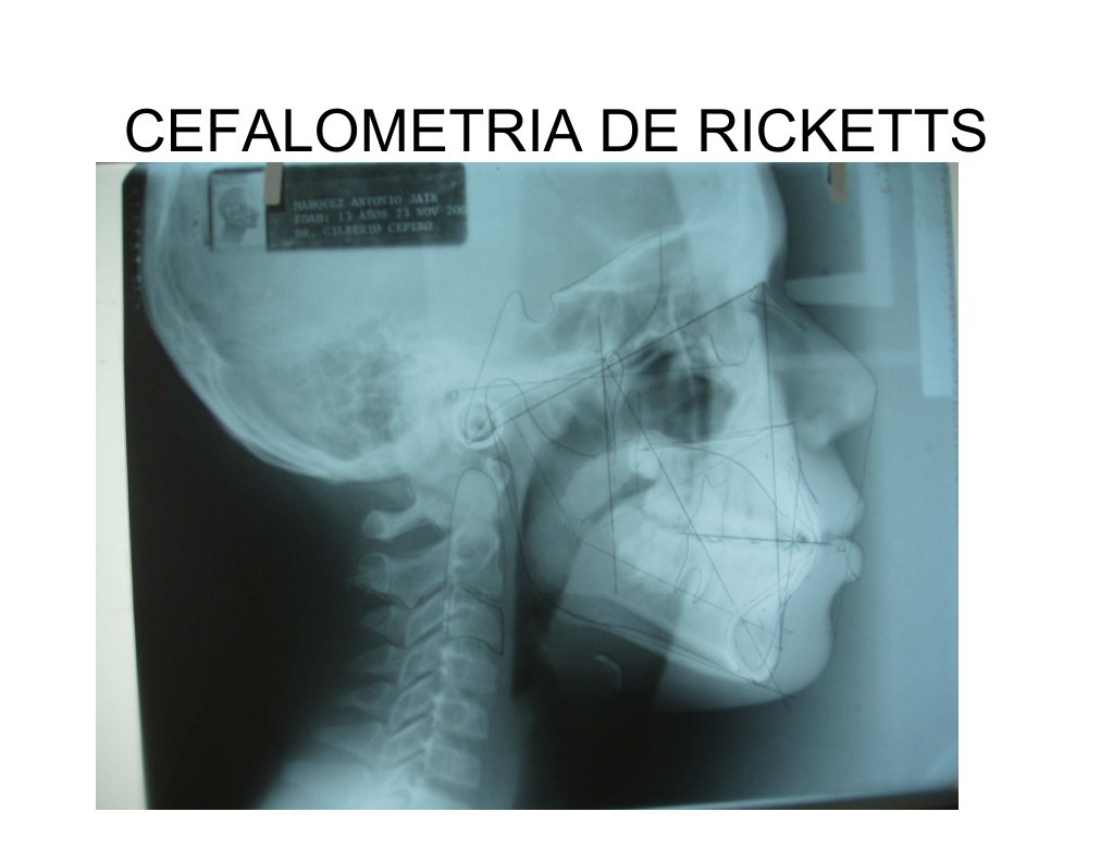 CEFALOMETRIA DE RICKETTS