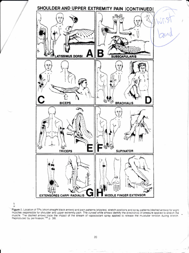 Shoulder & Upper Extremity Pain 2 | PDF | Soft Tissue | Musculoskeletal ...