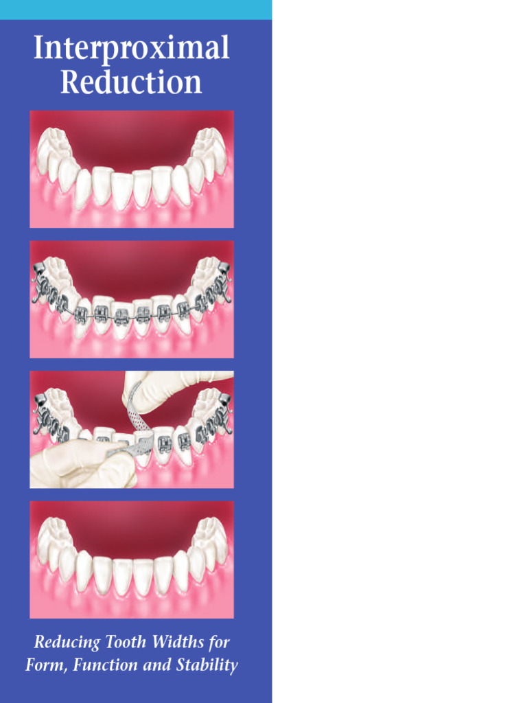 Interproximal Reduction | PDF | Orthodontics | Dentist