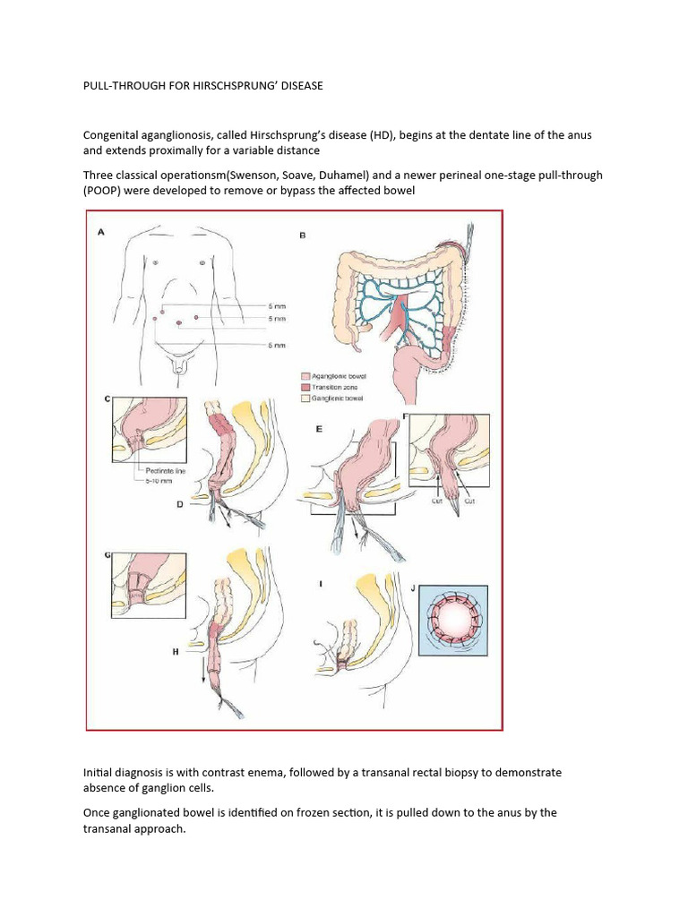 Konsiderasi Anes Transanal Pull-Through | PDF