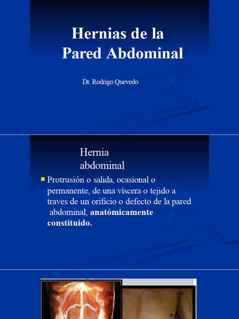 Hernias | PDF | Examen físico | Abdomen