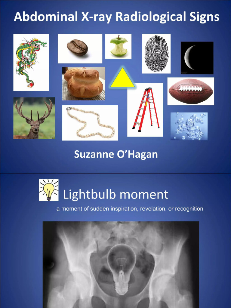 Abdomen Xray Signs | PDF