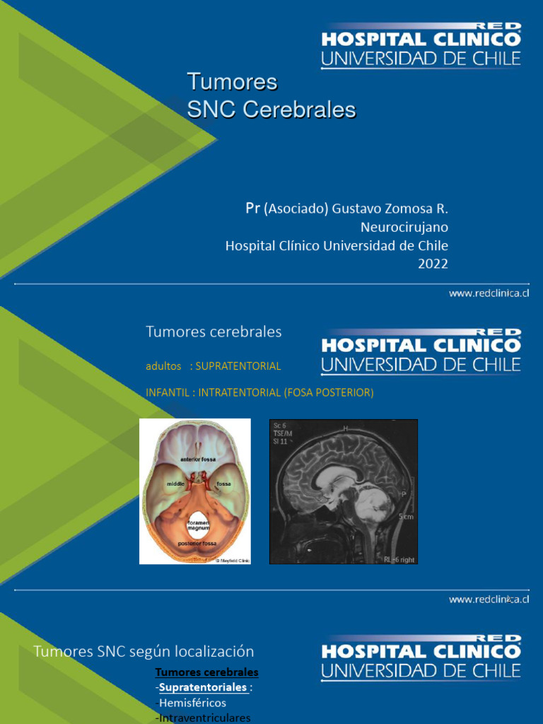 Clase Fono DR Zomosa TEC y Tumores | PDF | Glioma | Tumor cerebral
