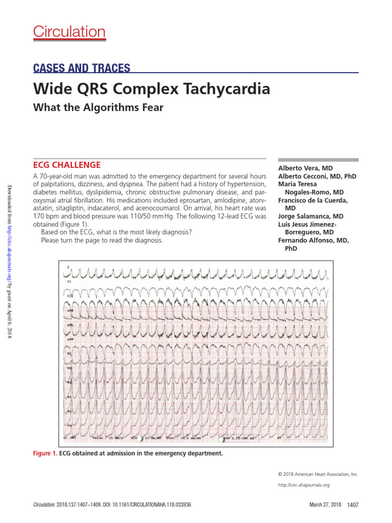 Wide QRS Complex Tachycardia What The Algorithms Fear | Download Free ...