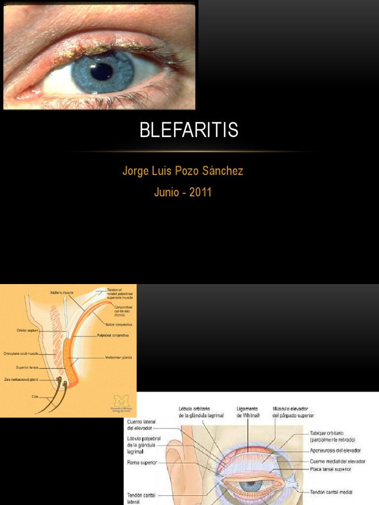 Blefaritis Oftalmosalud | PDF | Enfermedades y trastornos | Medicina CLINICA