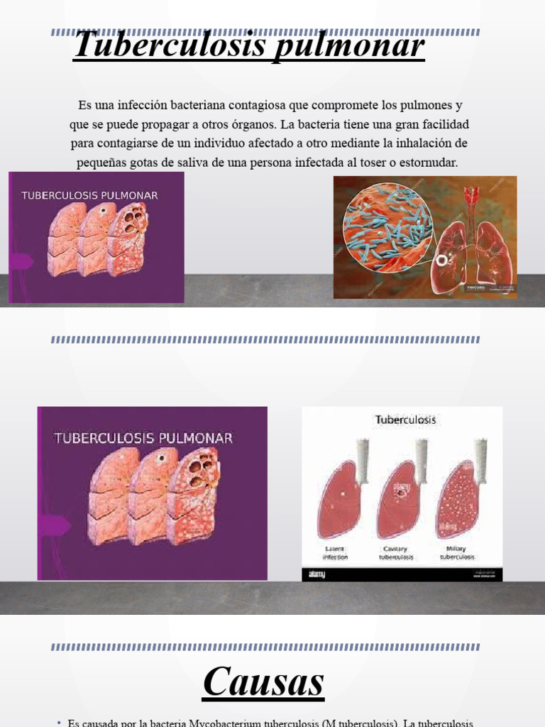 Guía sobre Tuberculosis Pulmonar | PDF | Tuberculosis | Tos