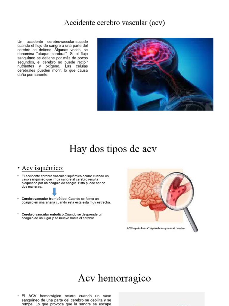 Accidente Cerebro Vascular (Acv) | PDF