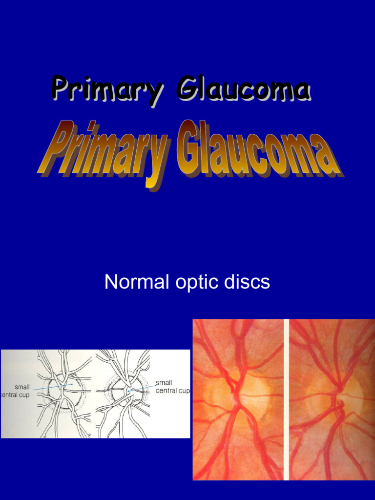8-Primary Glaucoma | PDF