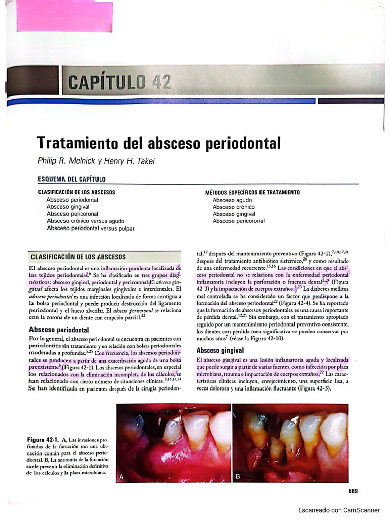 Abscesos Periodontales Cap 42 | PDF