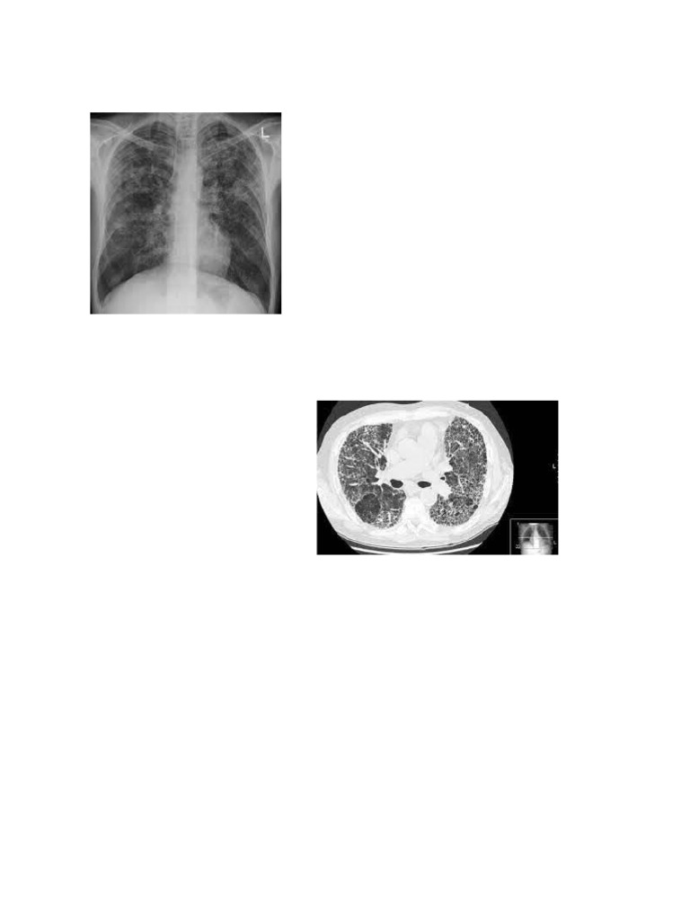 Fibrosis Pulmonar | PDF
