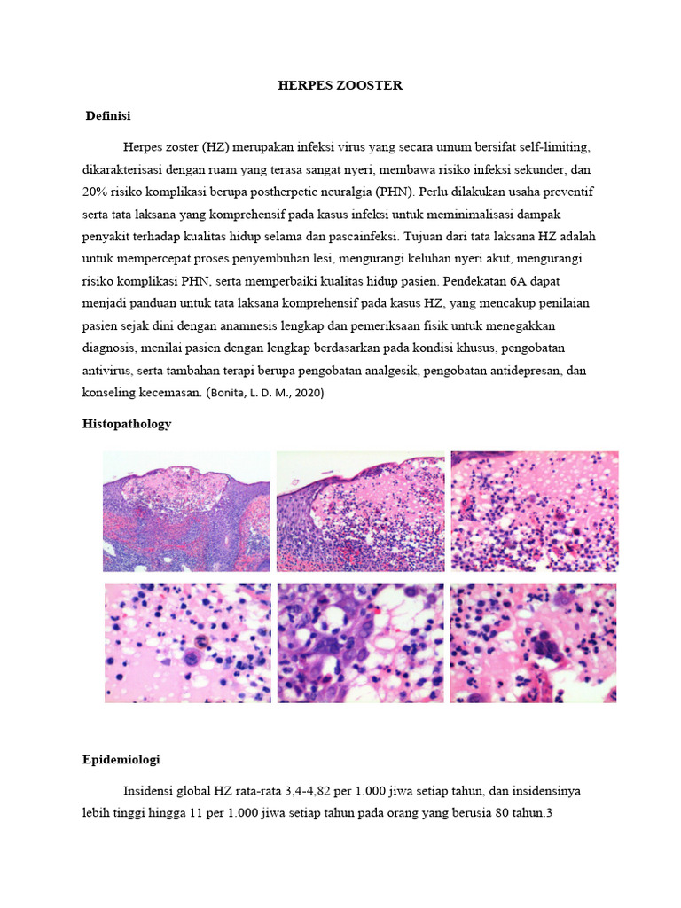 Herpes Zooster | PDF