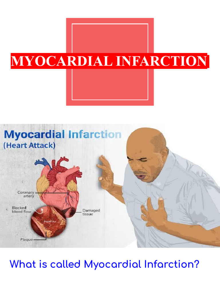MI.. Ms2 | PDF | Myocardial Infarction | Electrocardiography