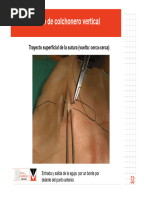 Guía de Sutura Colchonero Horizontal | PDF | Cirugía | Especialidades ...