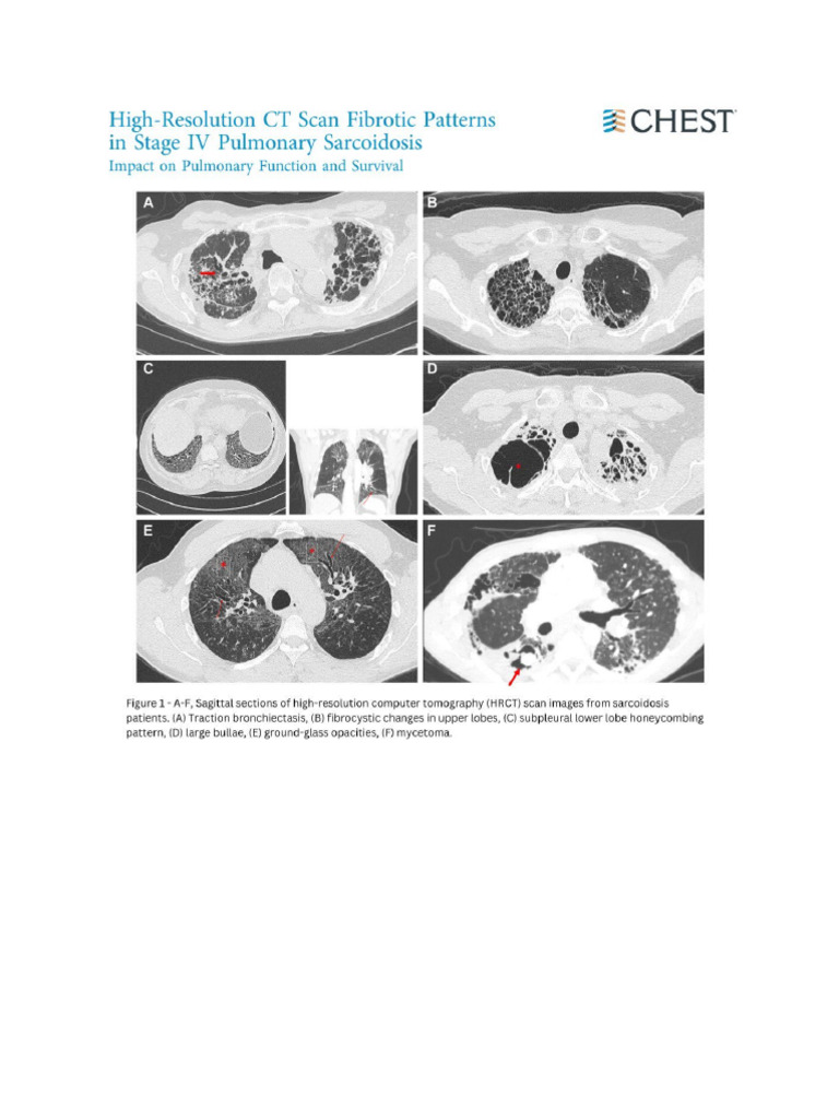 Sarcoidosis Ct Scan Pdf