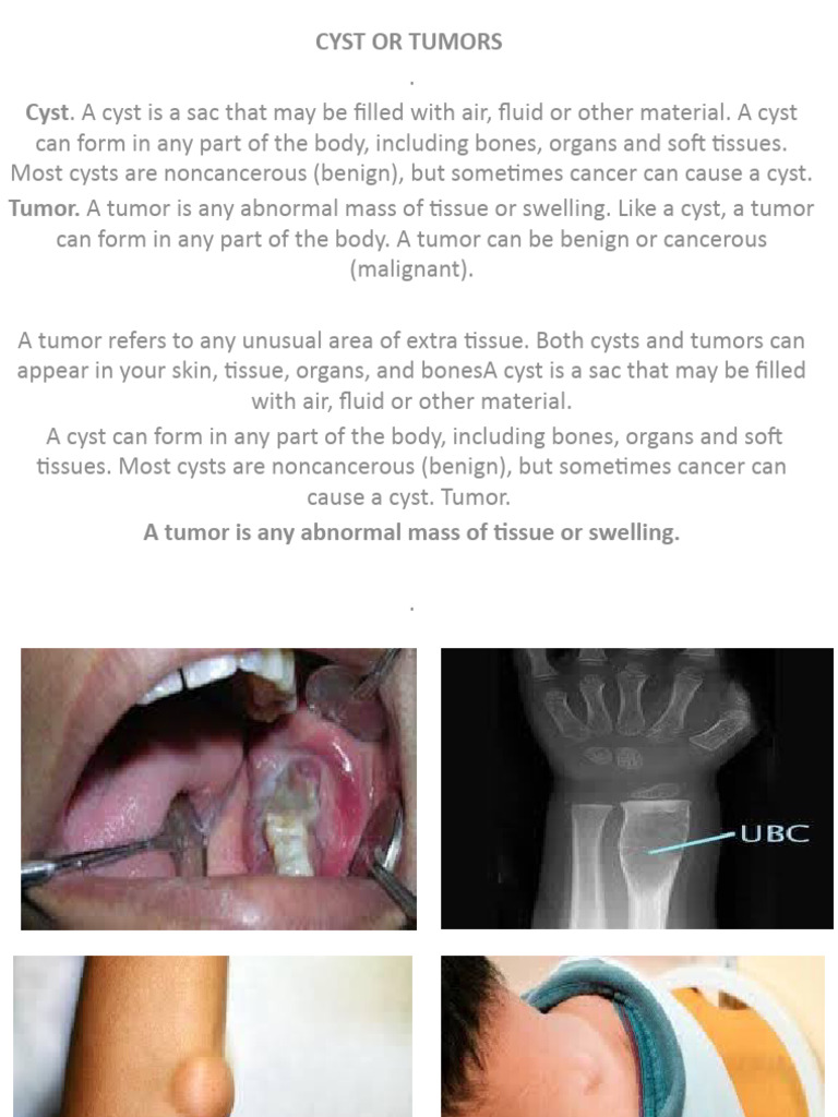 Cyst or Tumor | PDF | Cancer | Neoplasms