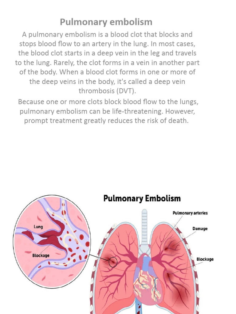 Pulmonary Embolism | PDF | Thrombus | Embolism