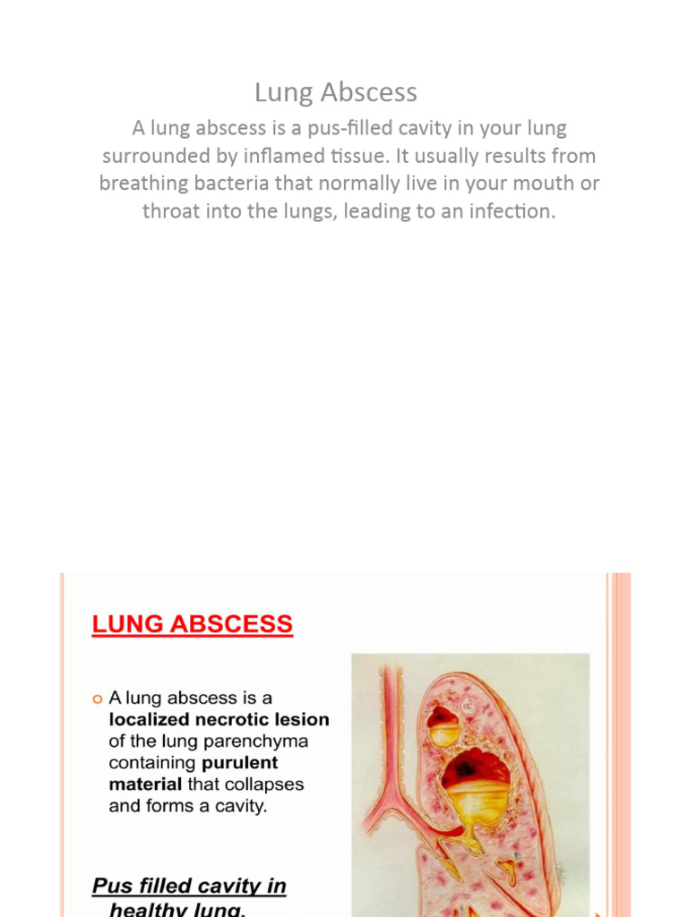 Lungs Abscess Ppt | PDF