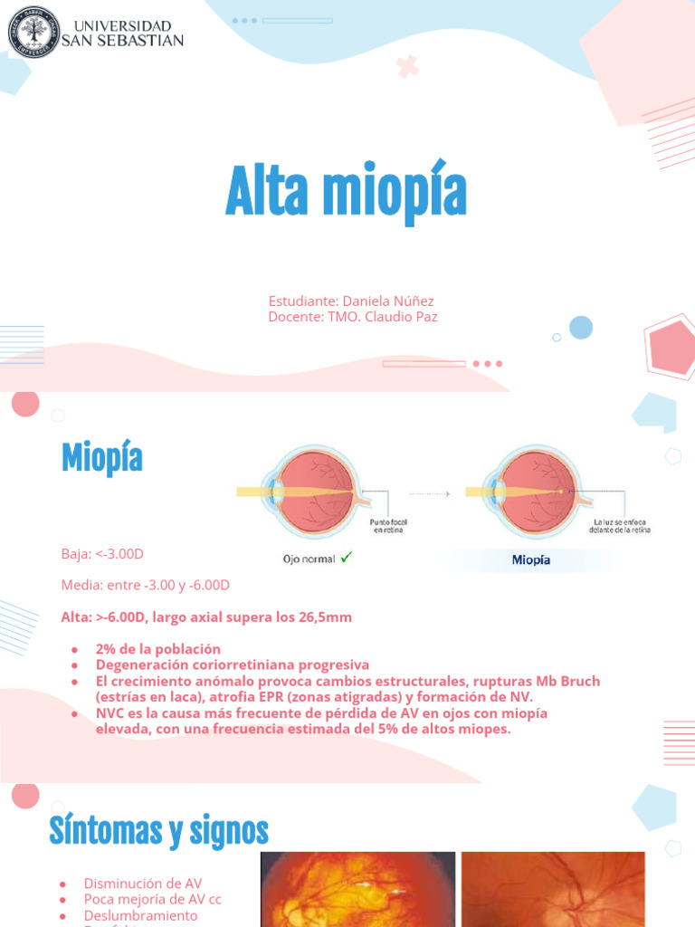 Alta Miopia | PDF | Especialidades Medicas | Medicina CLINICA