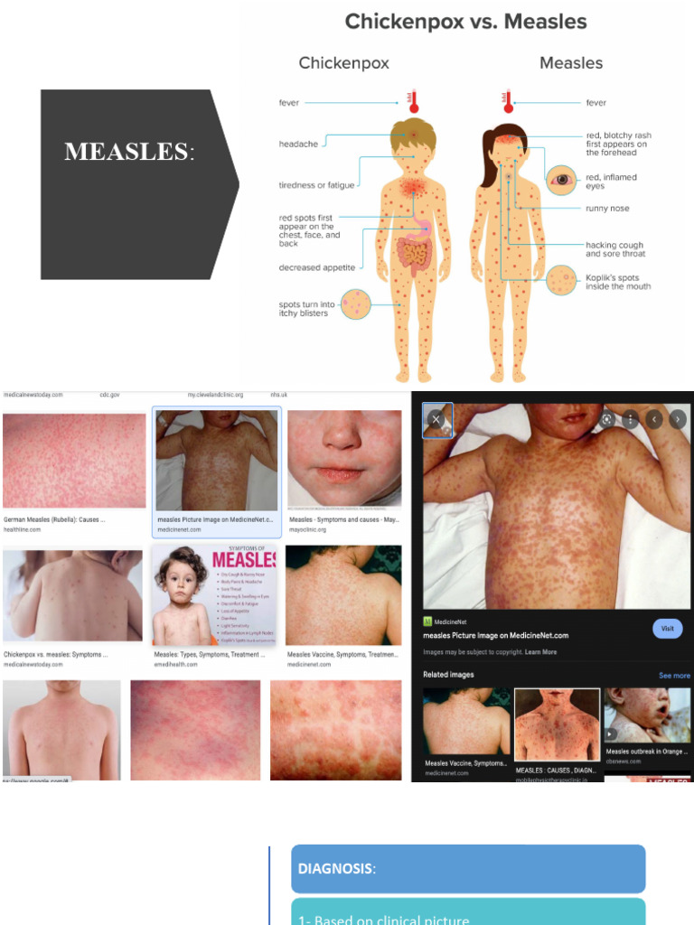 Measles Diagnosis and Management Guide | PDF | Measles | Animal Diseases