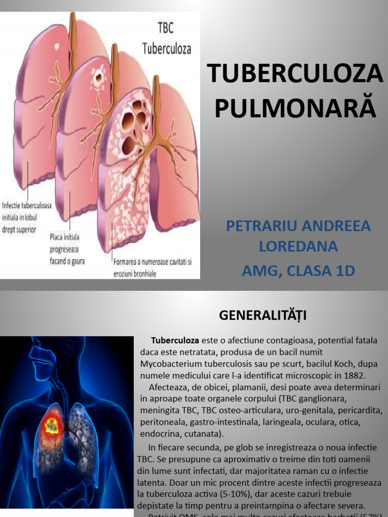 Tuberculoza Pulmonară | PDF