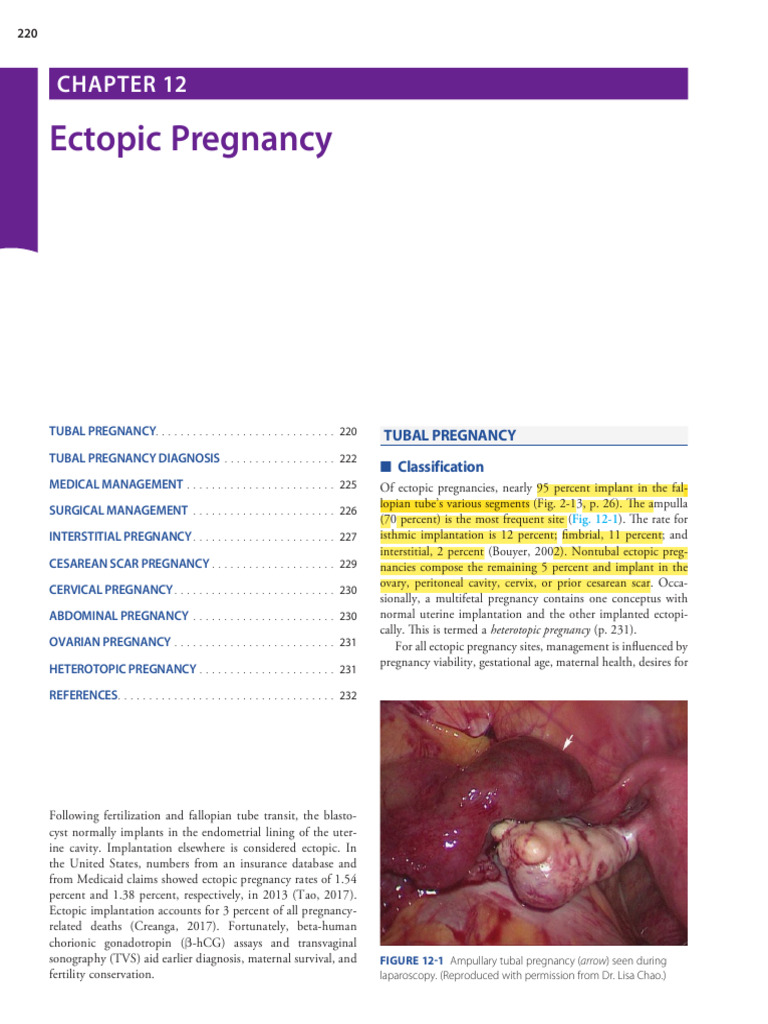 Ectopic Pregnancy | PDF
