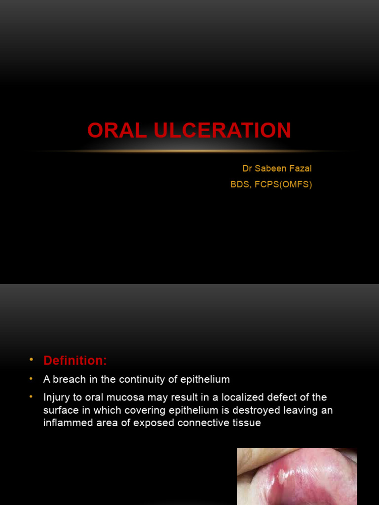 Oral Ulceration-2 | Download Free PDF | Diseases And Disorders ...