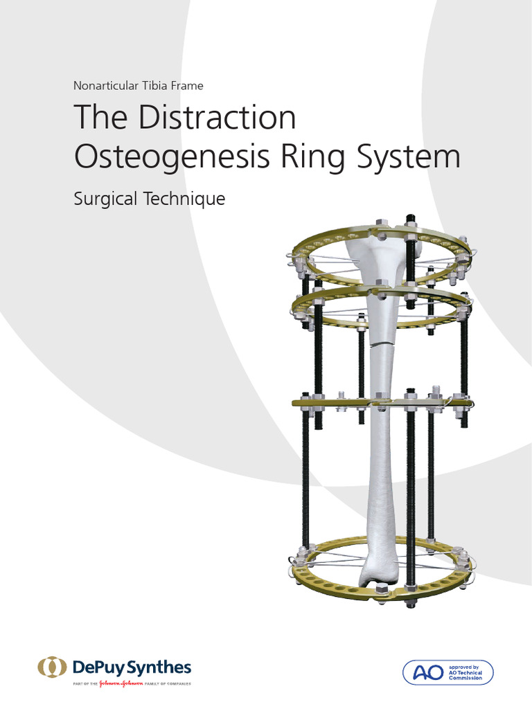 Distraction Osteogenesis Ring System Guide | PDF | Screw | Magnetic ...